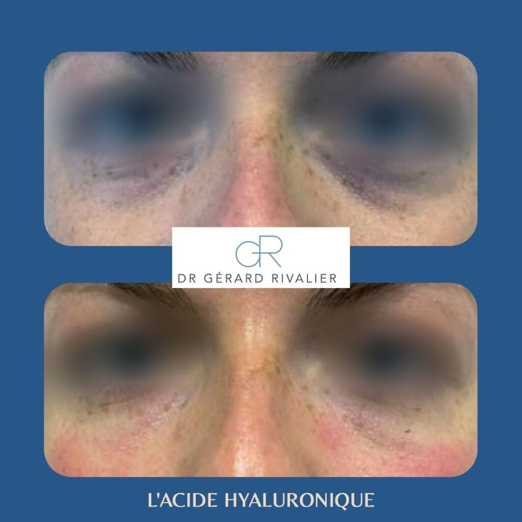 Avant/après injection d'acide hyaluronique | Dr Rivalier | Lyon
